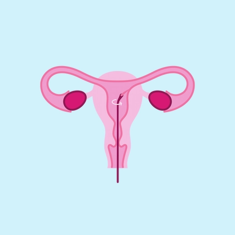 Endometrial scratching for IVF | Evidence-based IVF